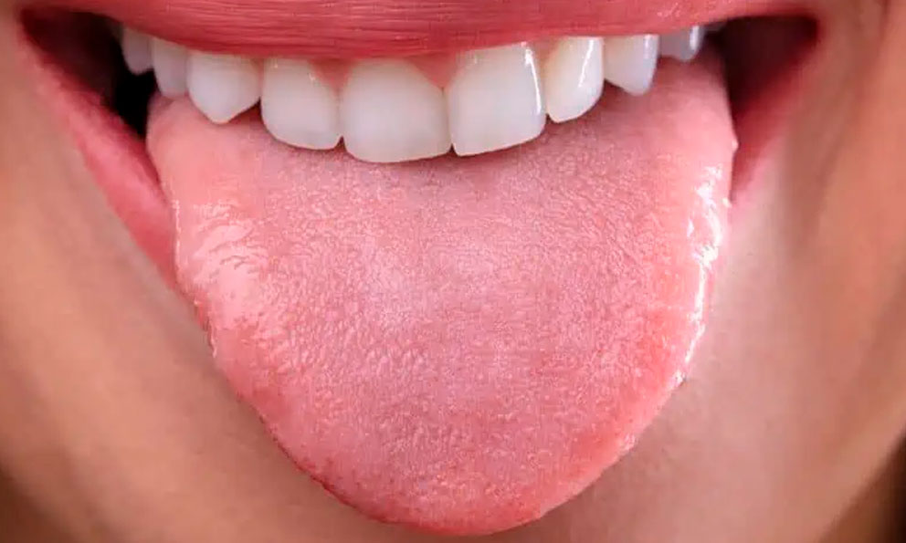 La lengua, sitio más frecuente de cáncer bucal
