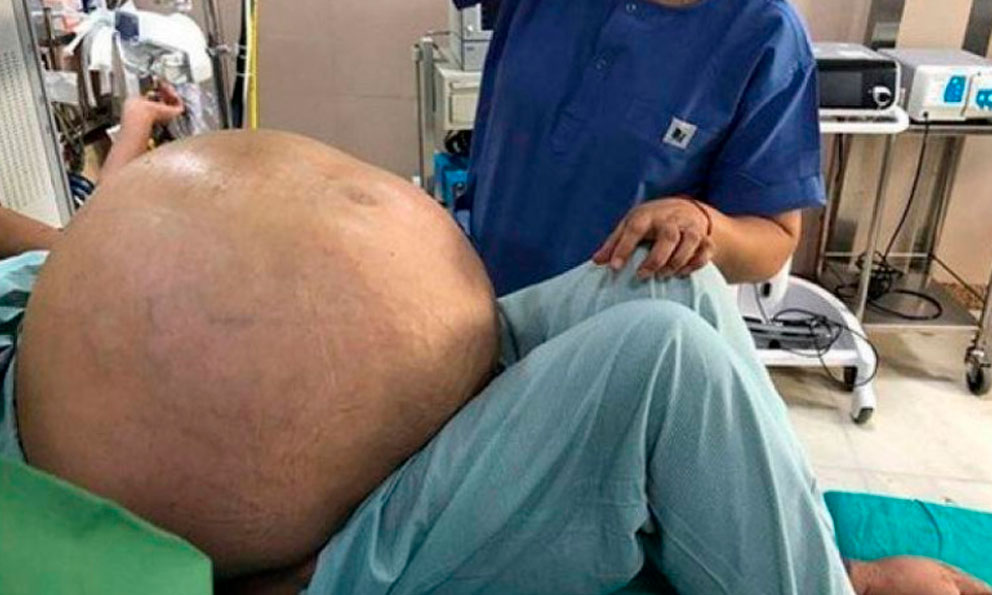 Extirpan un tumor de más de 50 kilos del abdomen de una mujer en Italia