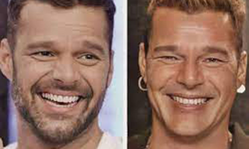 ¿Cirugía o alergia en Ricky Martin?