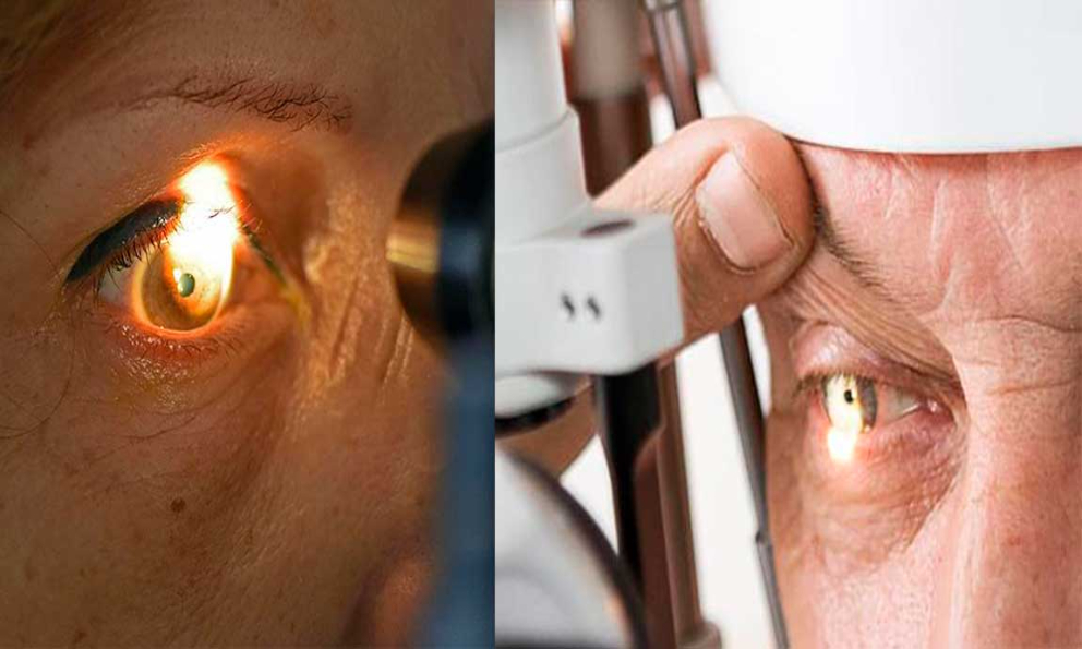 Glaucoma es la primera causa de ceguera en México